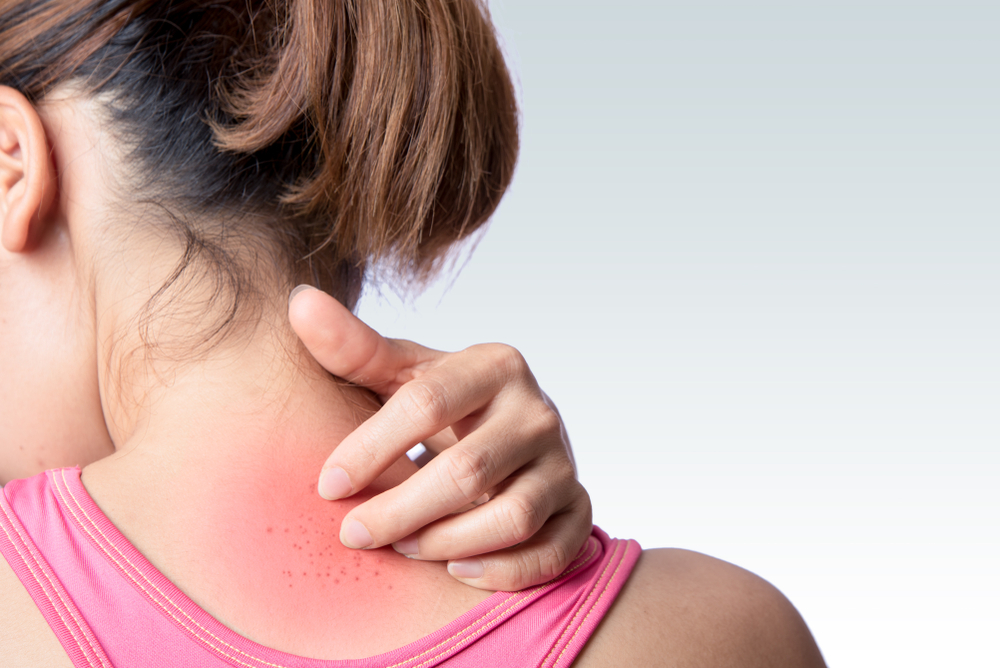 Allergic Rash Treatment and Testing | Columbia Allergy Clinics